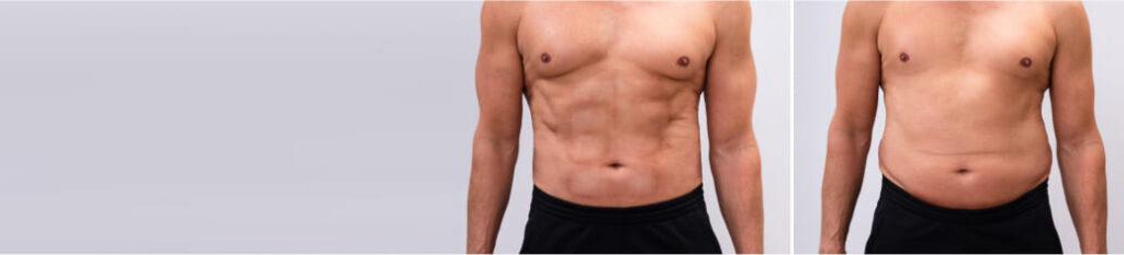 Procedure: VASER Hi-Def Liposculpturing - Visthetic Med Spa